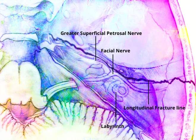 Longitudinal Fracture Of Petrous Temporal Bone