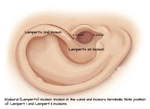 Tympanoplasty - Surgery steps, Approaches, PDF, Notes, PPT