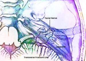 Fractures of Temporal Bone - Dr. Rahul Bagla ENT Textbook