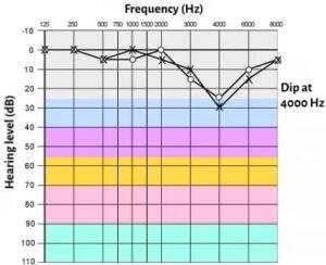 Noise induced trauma - Causes of noise-induced hearing loss