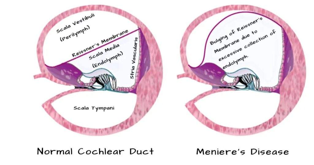 Meniere’s disease - Triad, Pathophysiology & Management – NEET PG ENT Notes