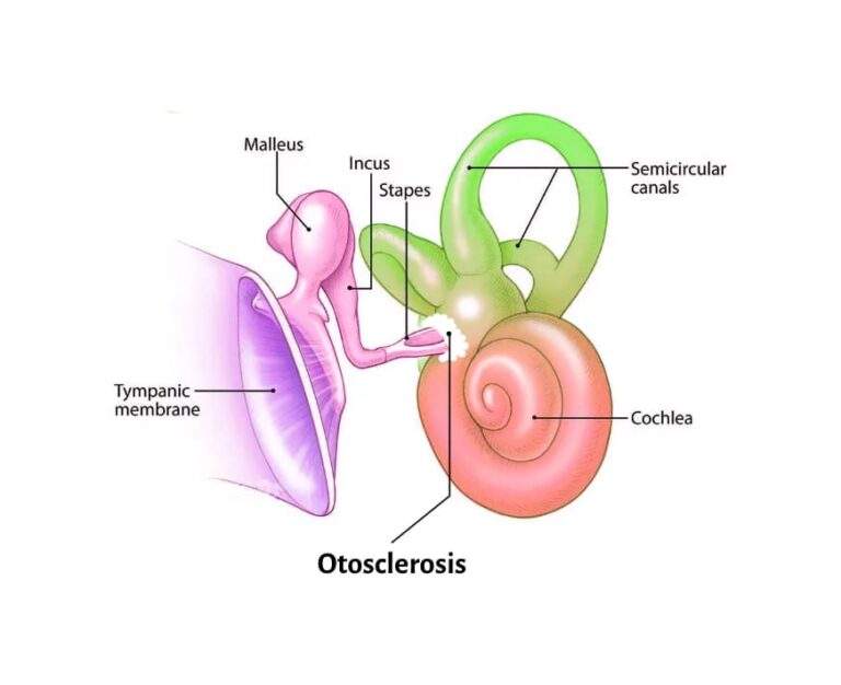 Otosclerosis - Carhart’s notch, fissula ante fenestram
