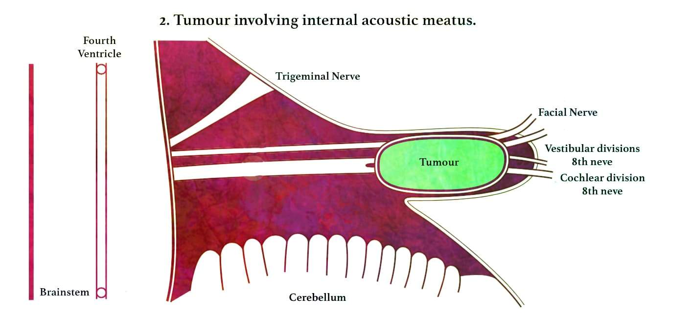 Vestibular Schwannoma - Earliest nerve involved in acoustic neuroma
