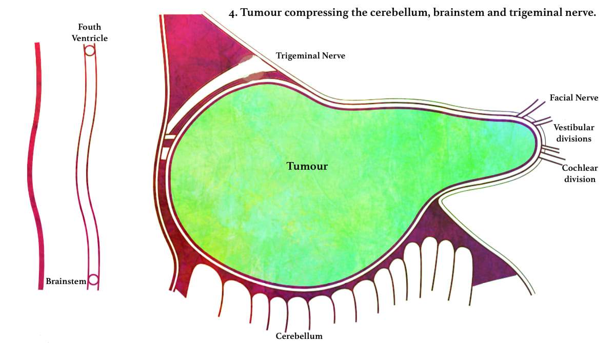 Vestibular Schwannoma - Earliest nerve involved in acoustic neuroma
