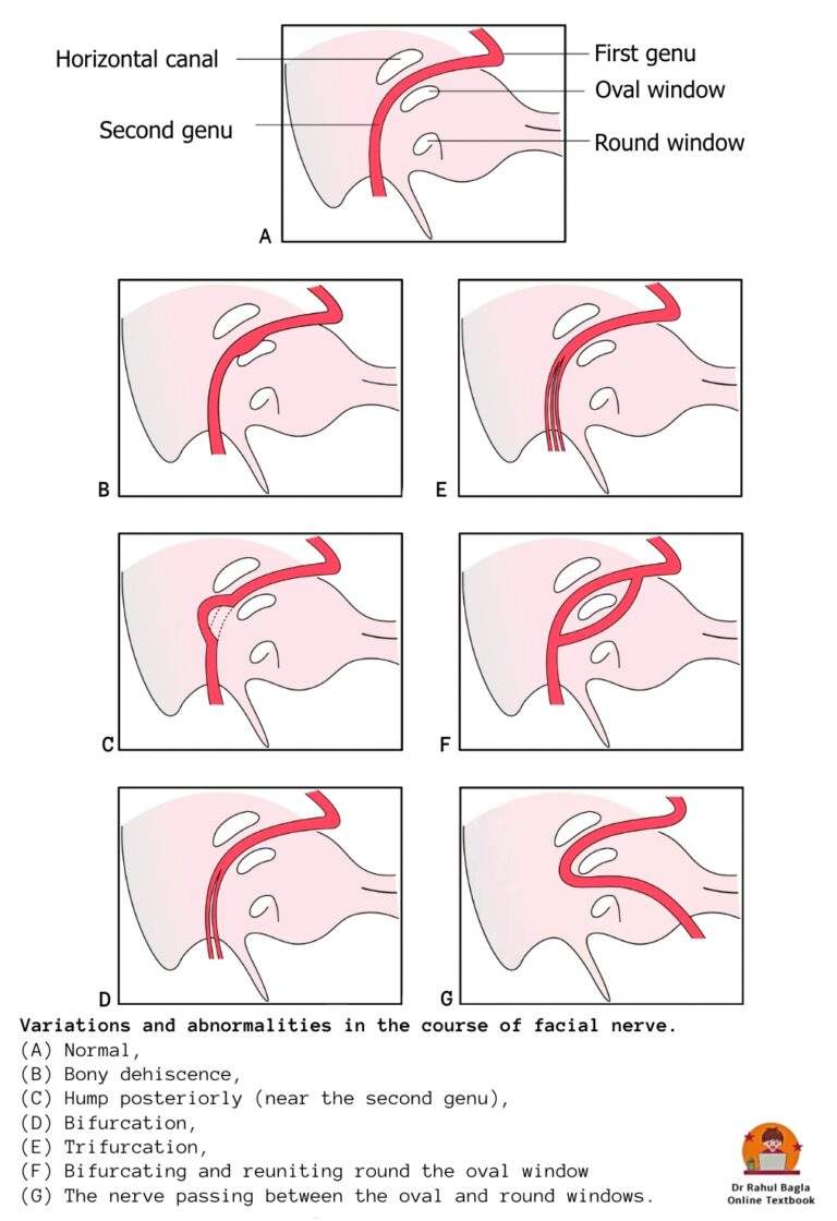 Facial Nerve Paralysis - Dr. Rahul Bagla ENT Textbook