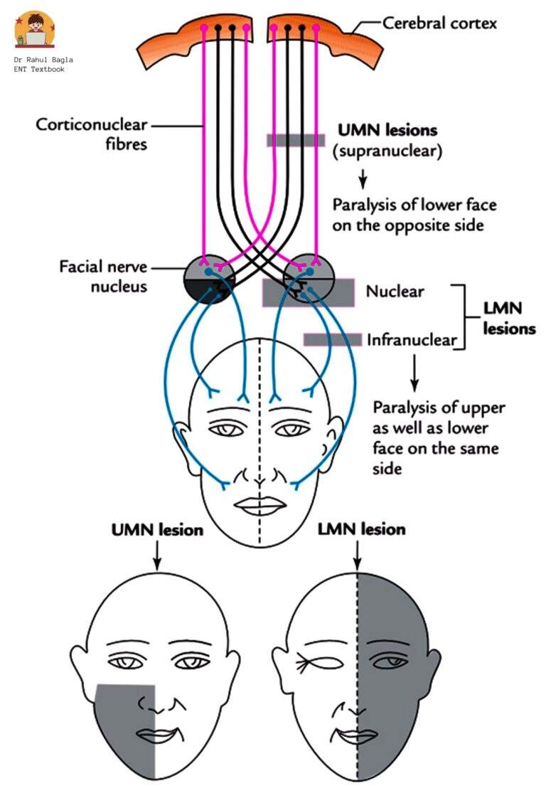 Facial Nerve Paralysis - Cause, Treatment, Best Notes, PDF, PPT