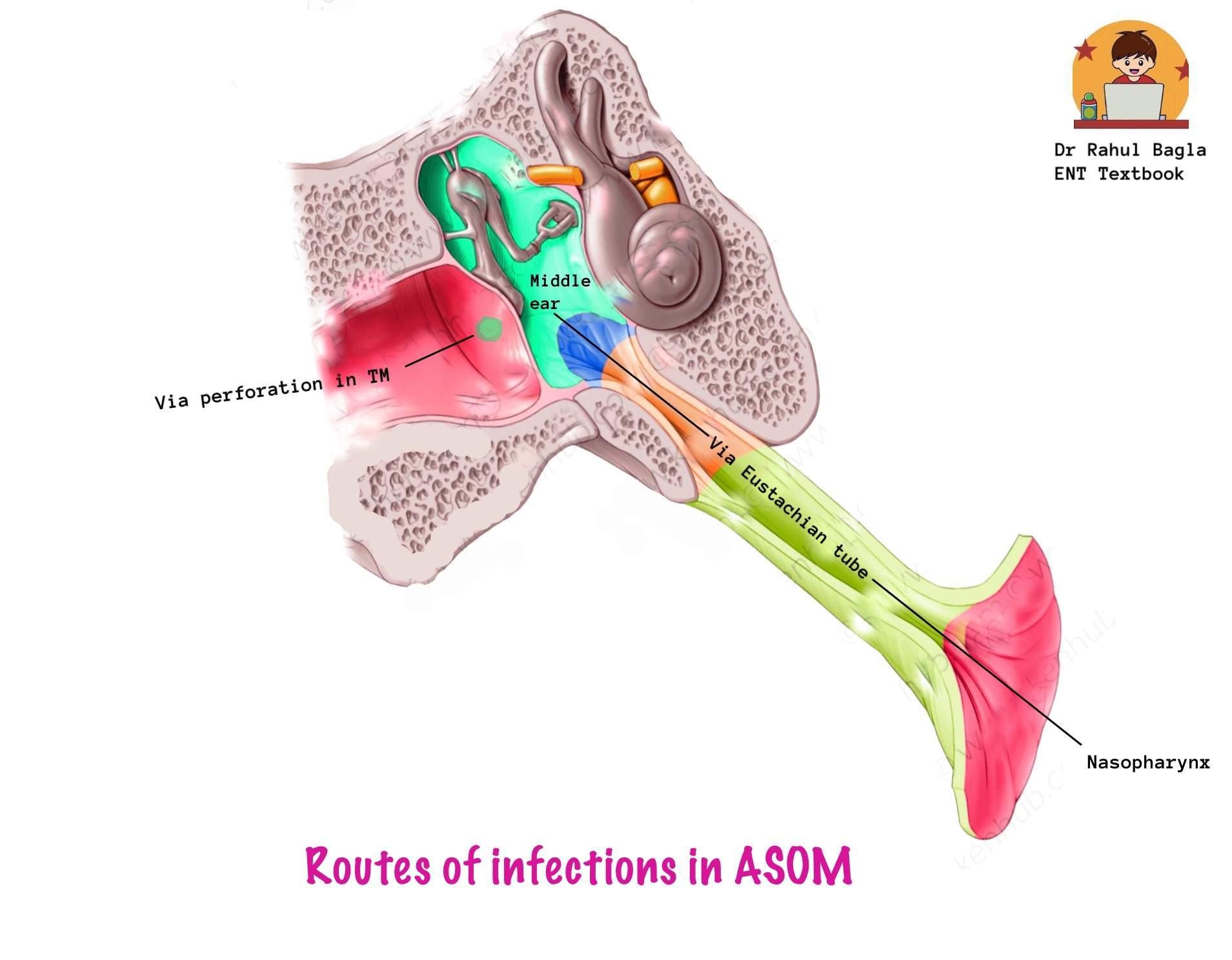 ASOM - Acute Suppurative Otitis Media - Lighthouse effect