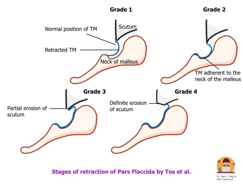 Retraction Pockets - Sade & Tos - Dr. Rahul Bagla ENT Textbook