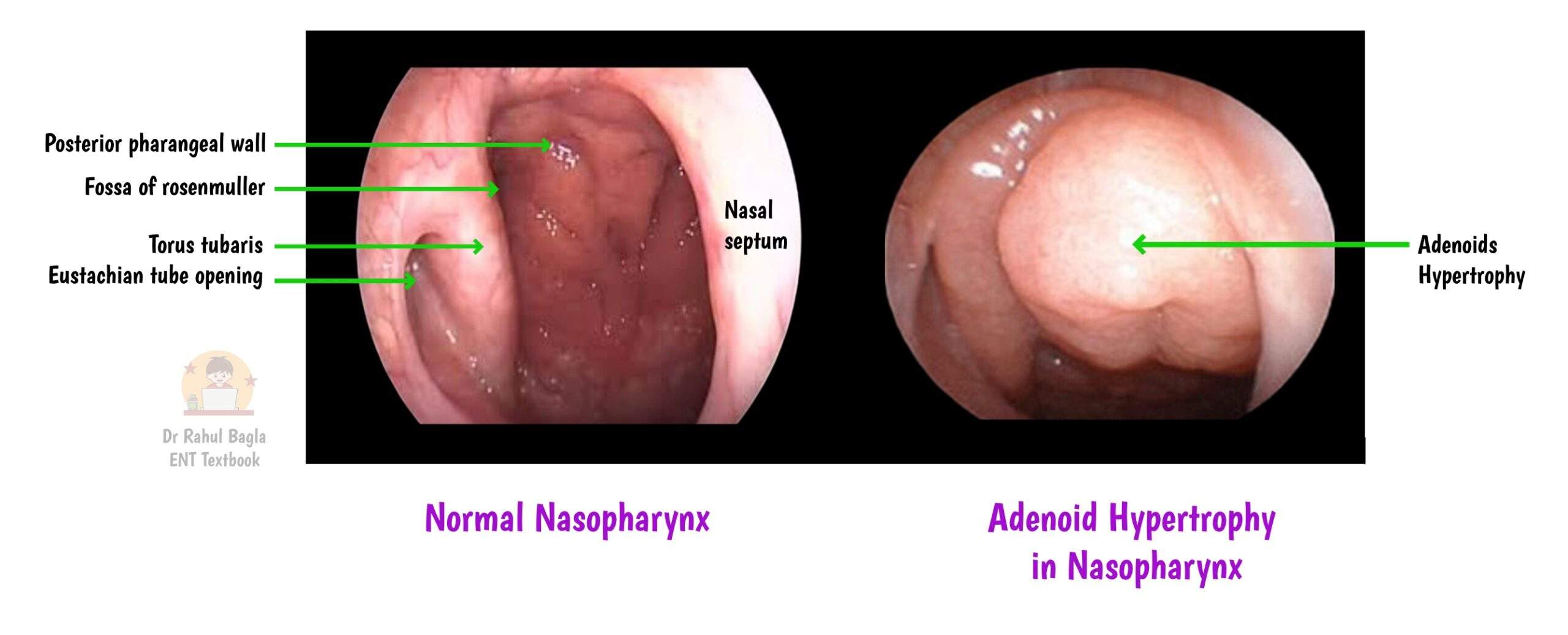Tonsils And Adenoids Diagram Tonsils And Adenoids Diagram
