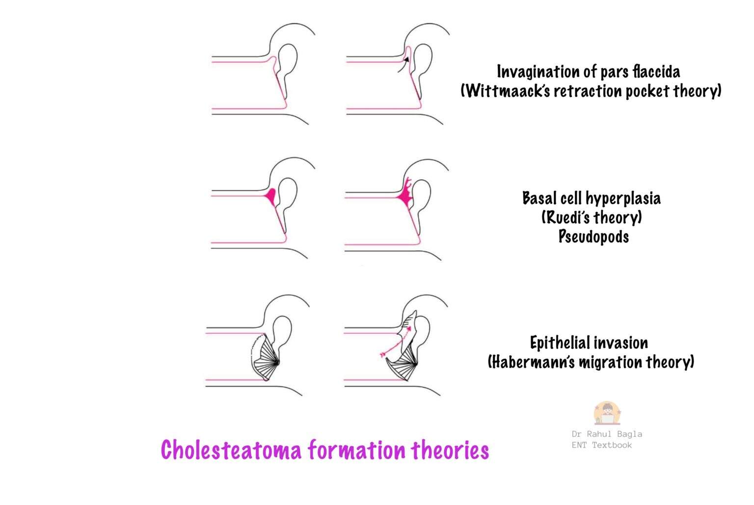 Cholesteatoma - Wittmaack, Ruedi, Habermann, Sade, Theories