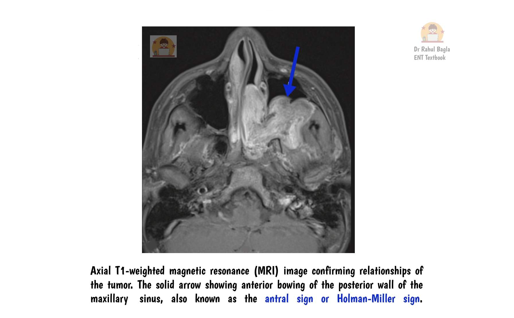 Juvenile angiofibroma - Advanced Imaging Techniques for JNA Diagnosis ...