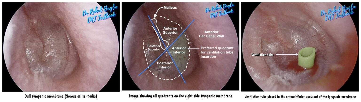 Otitis Media With Effusion - How Serous Otitis Media Affects Hearing ...