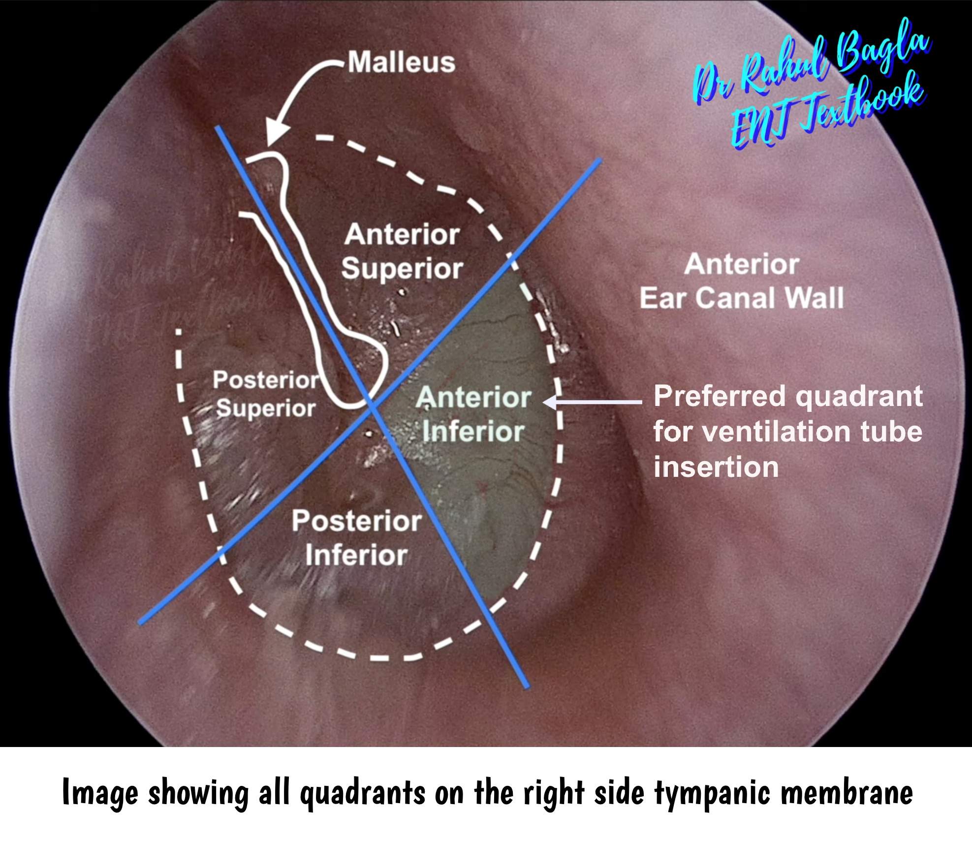 Myringotomy - Indications and Complications