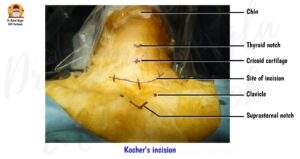 Thyroidectomy - "Thyroid Surgery Demystified: Everything You Need to ...