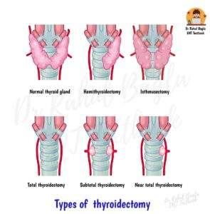 Thyroidectomy - "Thyroid Surgery Demystified: Everything You Need to ...