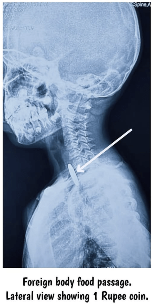 Foreign Body Oesophagus - Ultimate CBME, NEET PG Notes, X-ray Signs