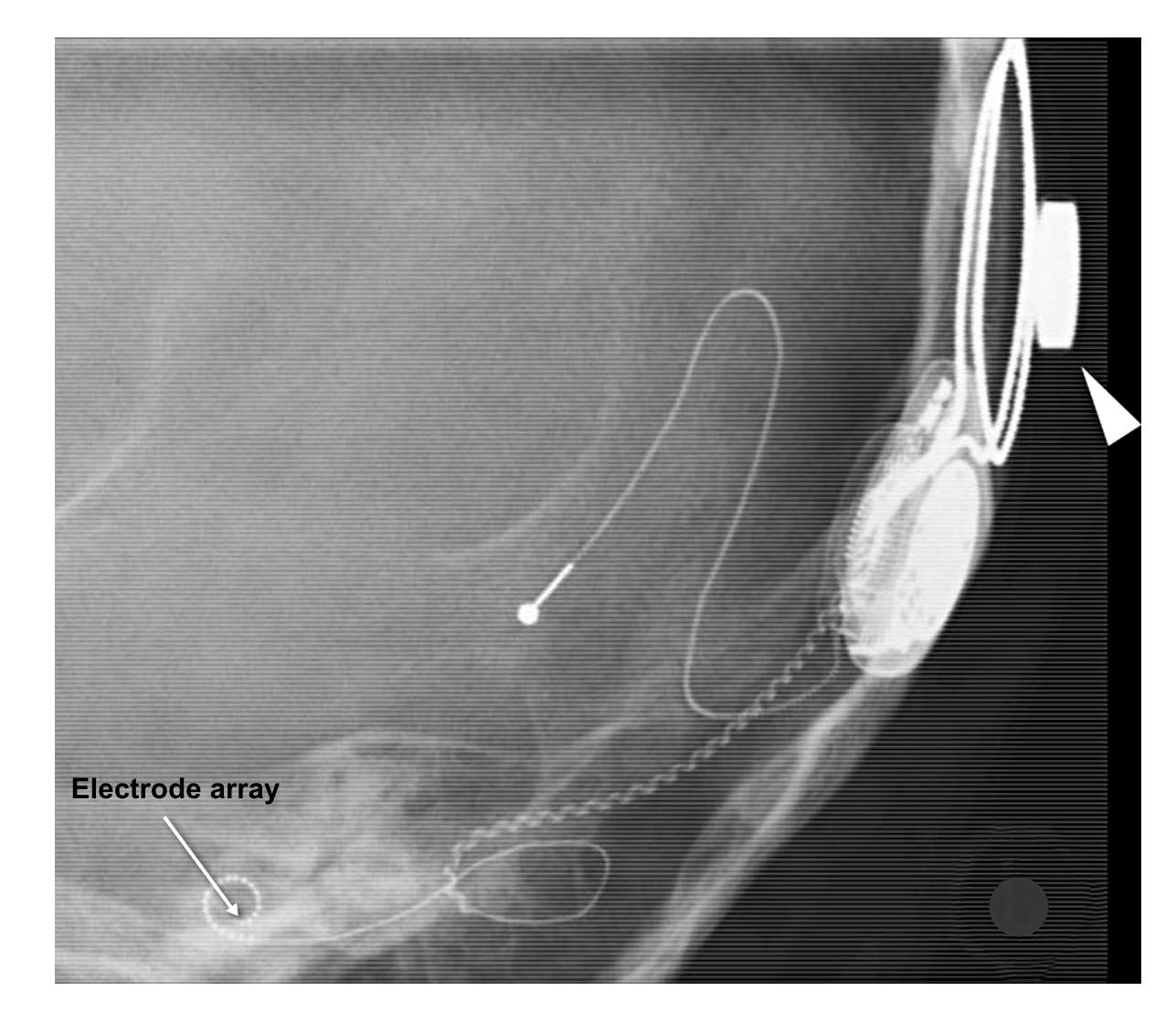 Cochlear Implant Surgery - Procedure, Benefits and Recovery Guide