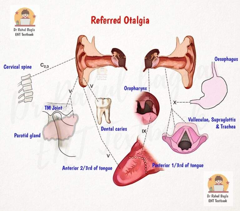 Otalgia - Primary vs. Referred Otalgia: Understanding the Difference