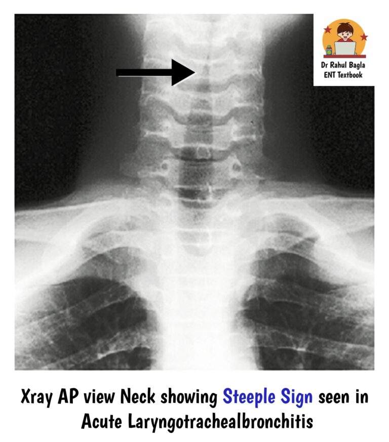 Acute Inflammations of Larynx - In Children & Adults