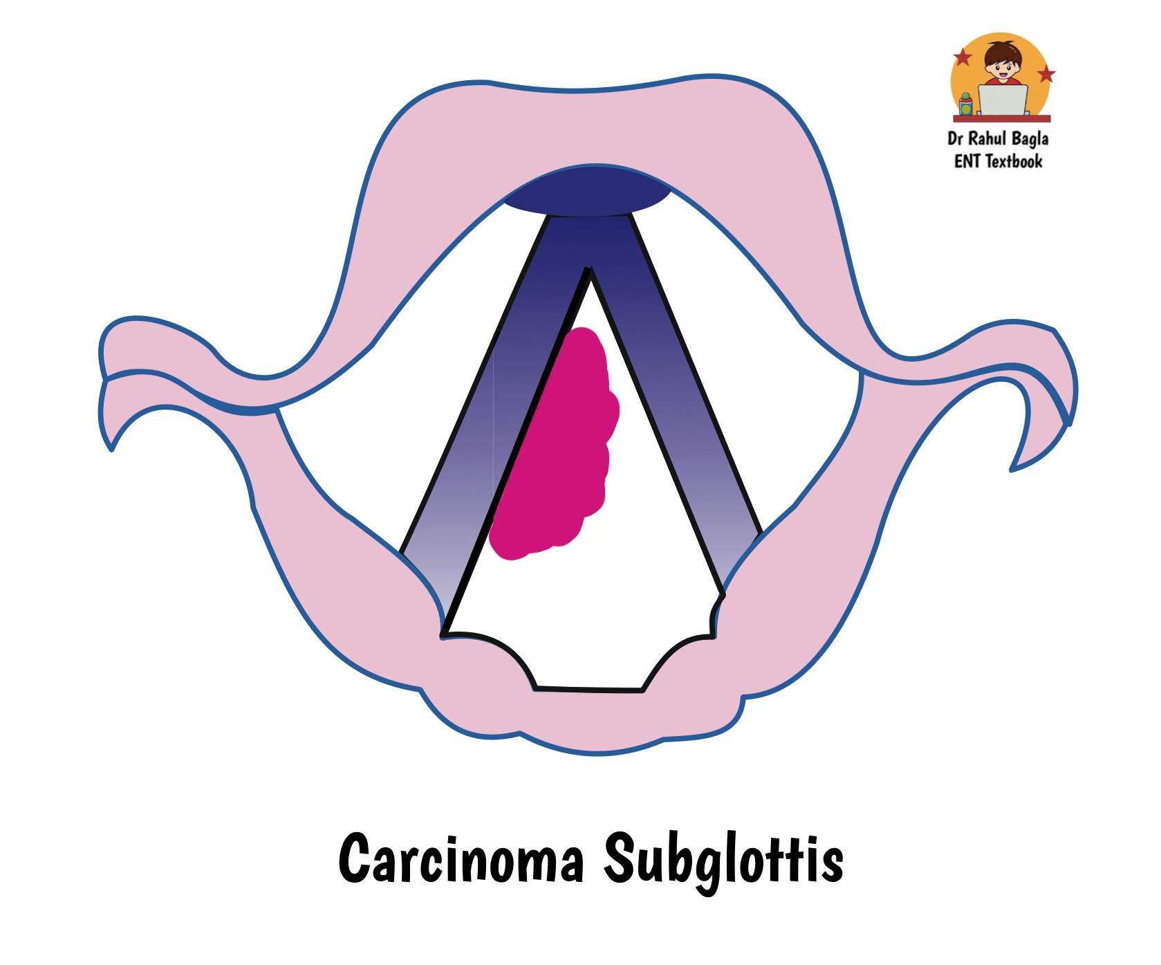 Carcinoma Larynx - Symptoms, Types, Spread & Treatment Guide