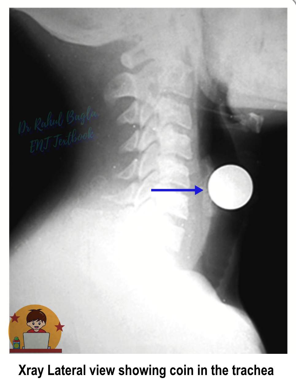 Foreign Body of Airway - Diagnosis, Management, MCQs & VIVA PPT