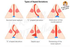 Diseases of Nasal Septum - Deviated Nasal Septum (DNS), Septal hematoma ...